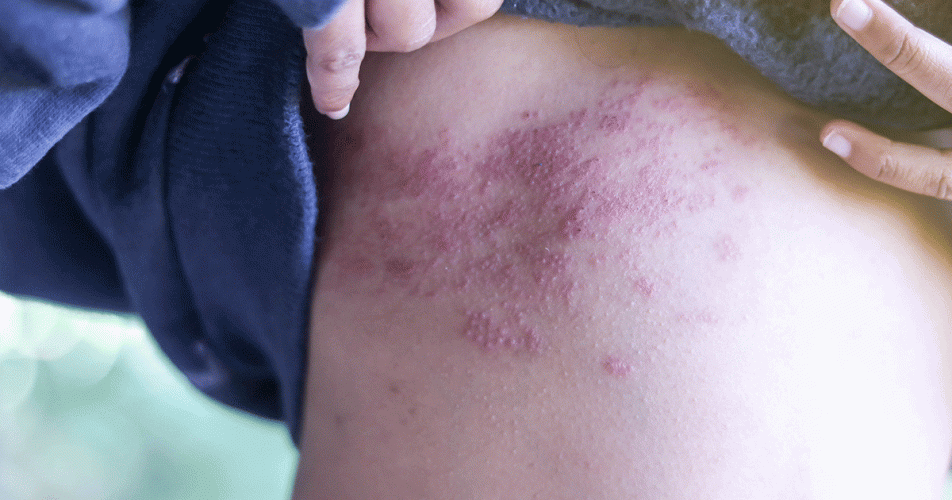 Shingrix to replace Zostavax on National Immunisation Program ...